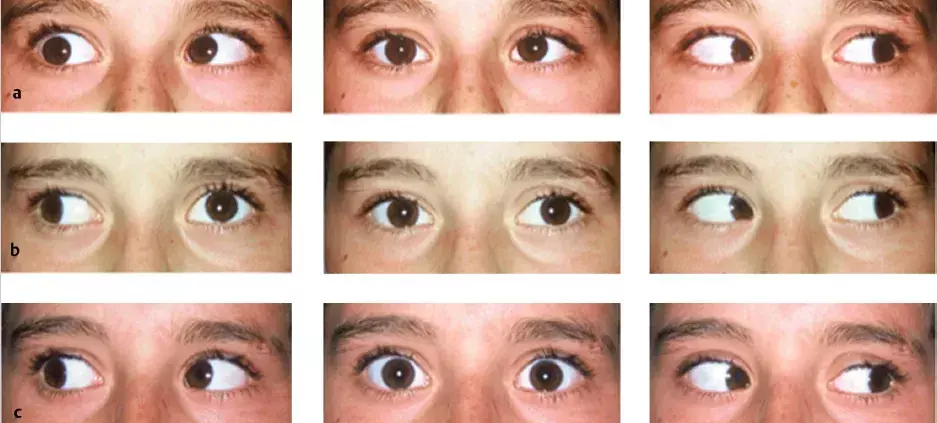 Bilateral medial rectus muscle injection with Botox safe and low-cost ...